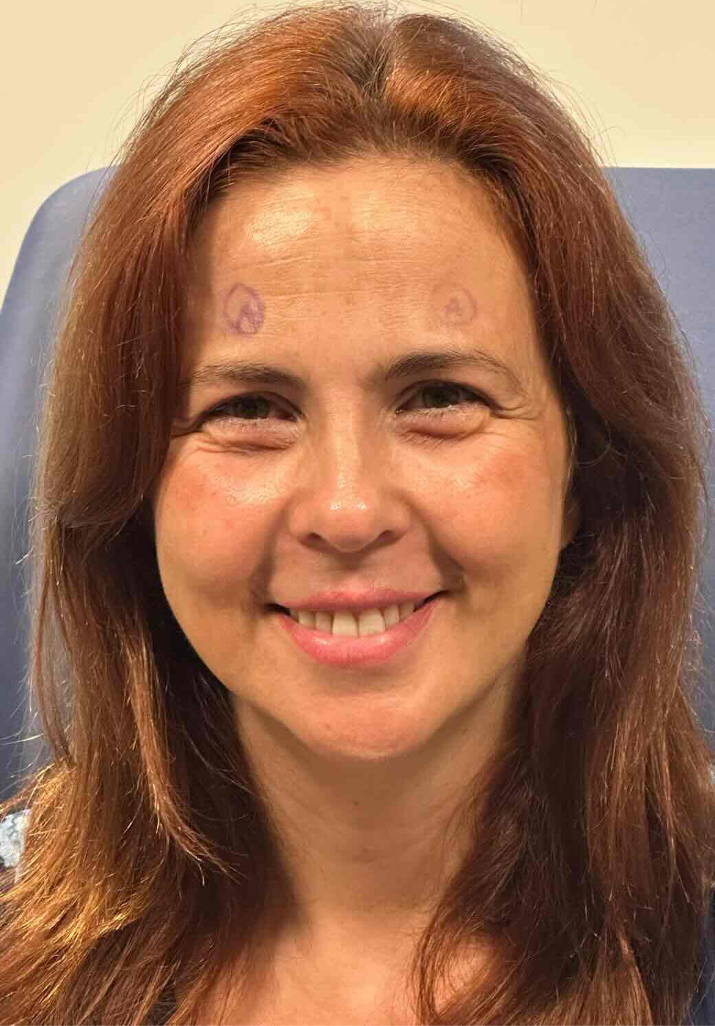 Trifocal Lens Implant Reviews in Turkey